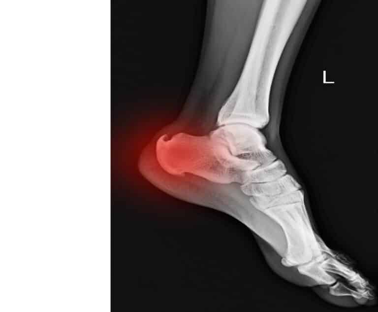 Bone Spurs: Everything You Need To Know | Grant Chiropractic